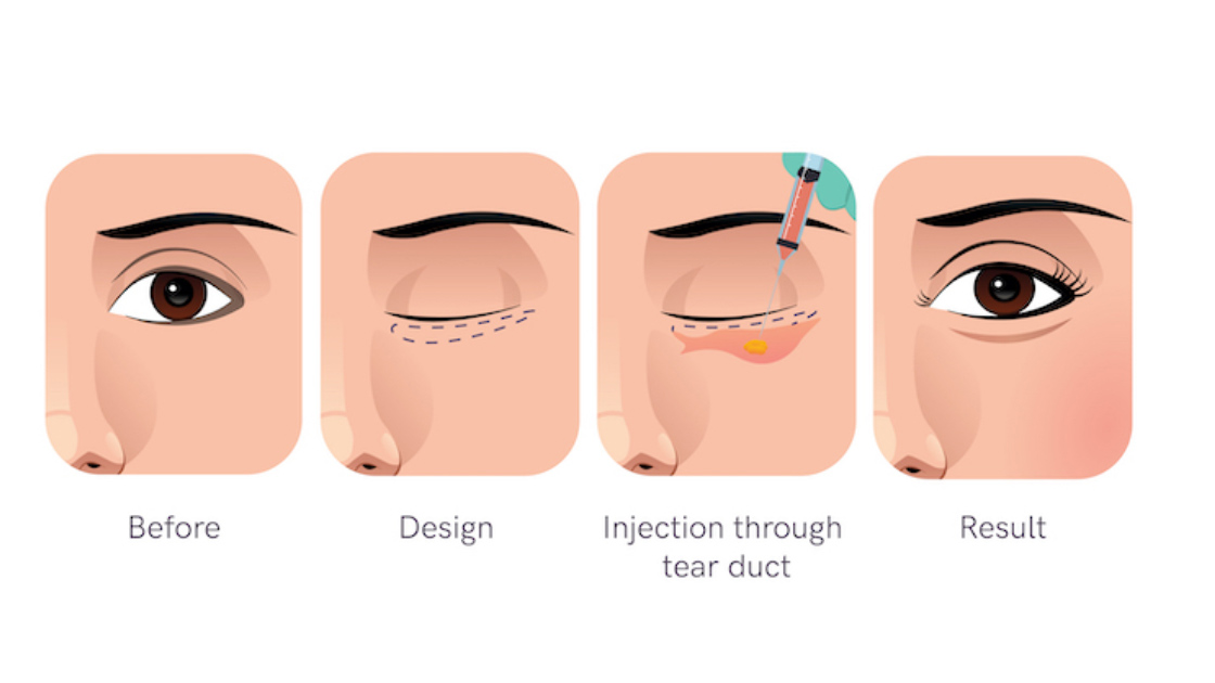 Love Band Surgery in Korea | Best Clinics, Costs, Procedure Types & More