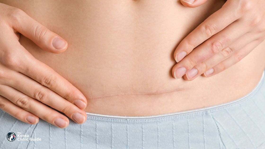 Scar Revision Surgery in Korea | Best Clinics, Costs, Procedure Types ...