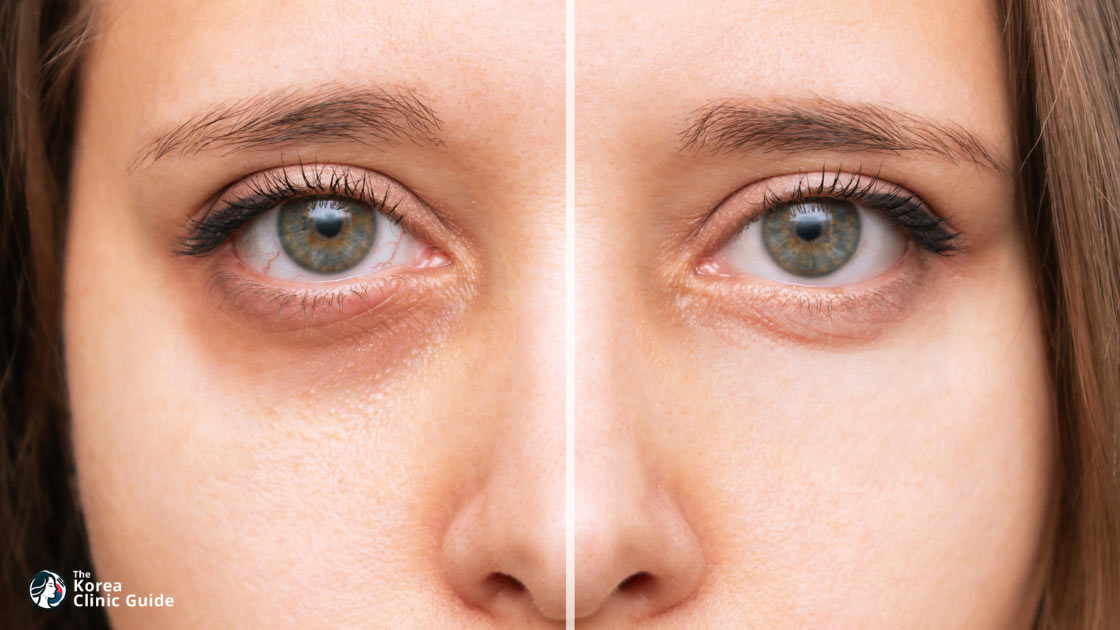 Dark Circle Injection in Korea | Best Clinics, Costs, Procedure Types ...